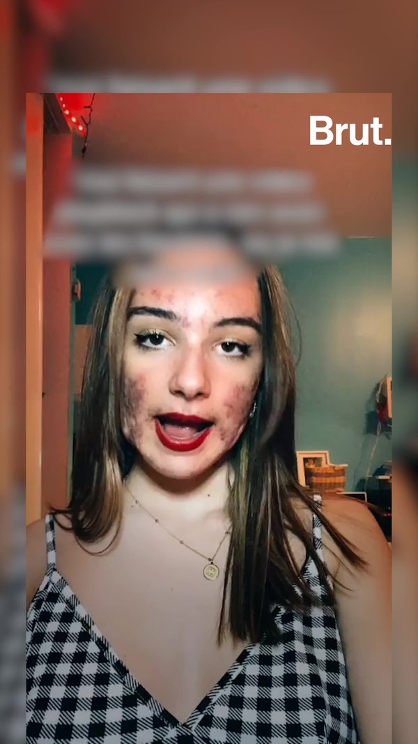 Mattéa sufre acné severo y cuenta su día a día en TikTok | Brut.